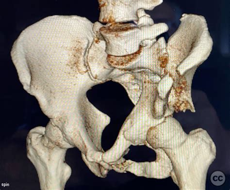 Associated Both Column Acetabular Fracture Sequential Orif Via