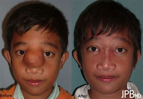 Encephalocele Correction Nyc James P Bradley Md