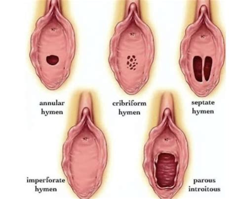 What Is Hymen And Type Of Hymen In Young Woman