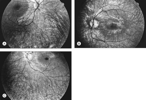 Retinitis Pigmentosa And Allied Disorders Ento Key