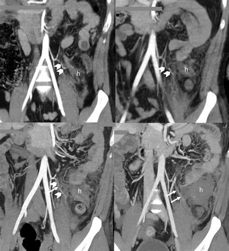 Abnormal Mesenteric Vessels A D Blunt Mesenteric Hematoma Colonic
