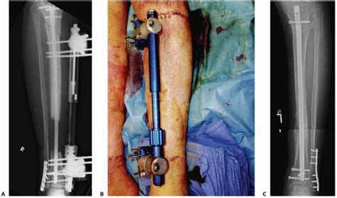 Dip Dislocation Teachme Orthopedics