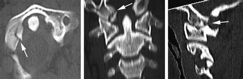 Occipital Condyle Fracture Clinical Case And A Review Of The
