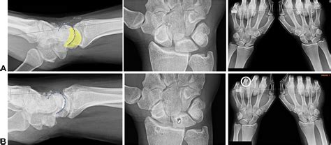 One Year Outcomes Of The Anatomical Front And Back Reconstruction For