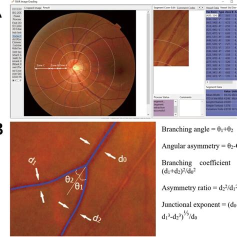 A Retinal Vascular Geometric Variables Assessed Quantitatively By The