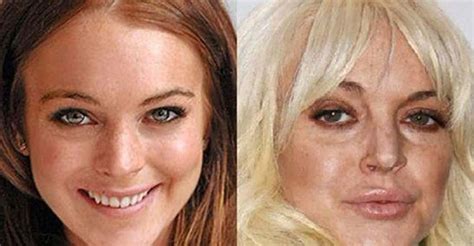 19 Freaky Cases Of Lip Injections Gone Wrong