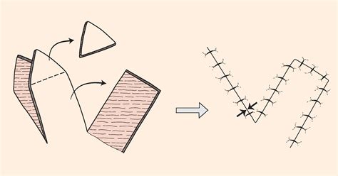 Flap Classification And Design Clinical Tree