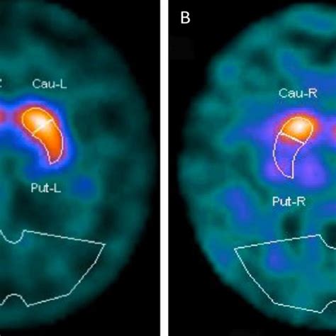 A 71 Years Old Male With Nyha Class Ii Heart Failure Demonstrates