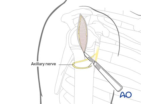 Lateral Approach With Deltoid Splitting