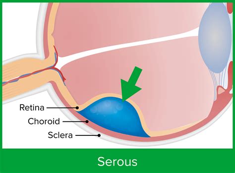 Serous Retinal Detachment Differential Diagnosis