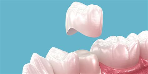 Learn What Is A Tooth Cap And What It Can Do For You Direct Dental