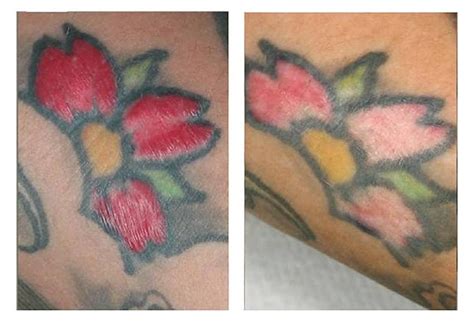 Infections In Tattoos