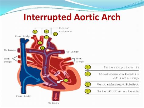 Classification A Cyanotic Interrupted Aortic Arch Aortic Stenosis