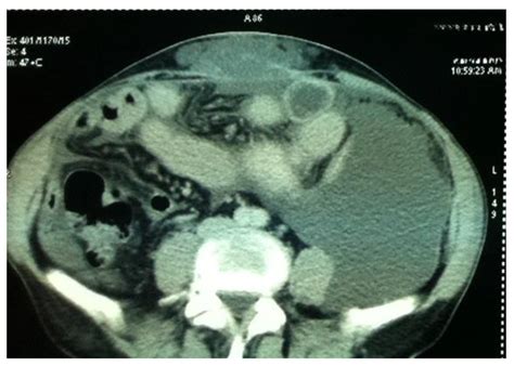Status Of And Challenges In Therapy Of Mucinous Ovarian Cancer