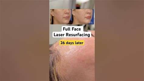 Erbium Contour Trl Laser 💥 Youtube