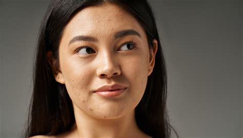 Microneedling For Acne Scars Does It Work Kure Aesthetics