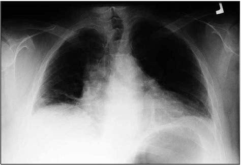 Oboustranná Léze N Phrenicus Manifestující Se Jako Ortopnoe Kazuistiky Tří Případů Česká A