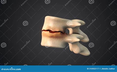 Disc Degeneration With Osteophyte Formation In The Human Spine Royalty