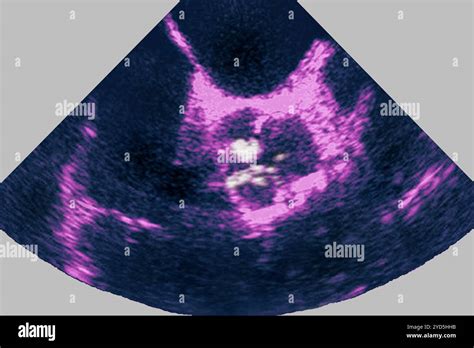 Calcified Heart Valve Disease The Tricuspid Valve Separates The Right