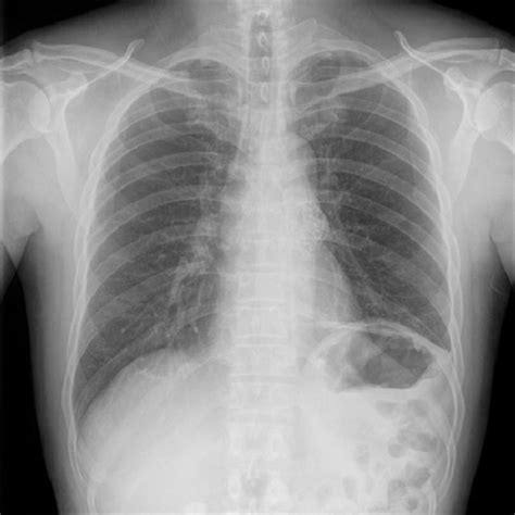 Chest X Ray Showing Mediastinal Calcification Download Scientific