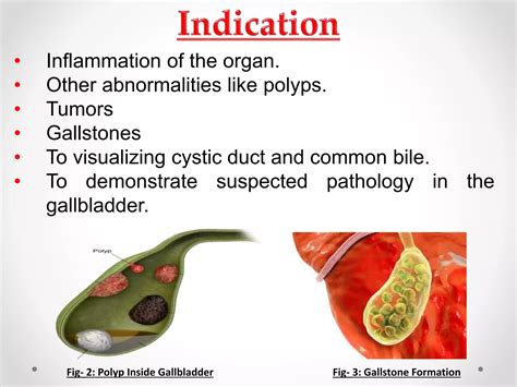Ocg Oral Cholecystogram By Akash Das Pptx