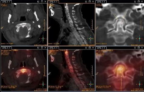 Crowned Dens Syndrome Practical Neurology