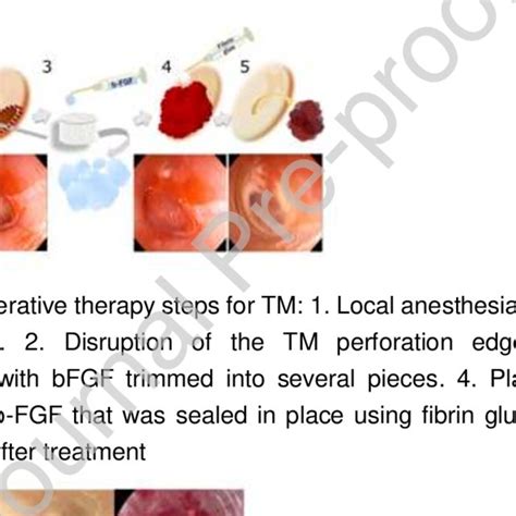 Pdf In Office Patch Myringoplasty