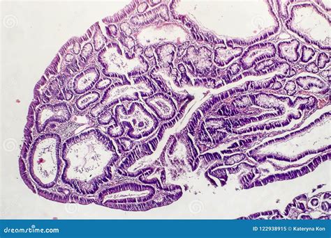 Intestinal Polypoid Adenoma Stock Image Image Of Microscope Micro 122938915