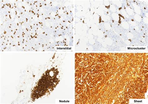 浆细胞骨髓瘤的骨髓形态学特征、myprs 和基因突变相关性。modern Pathology X Mol