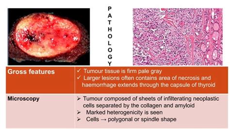 Pathogenesis Of Thyroid Carcinoma Ppt