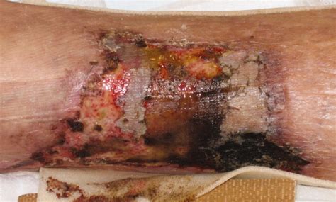 Lower Extremity Ulcers Mdedge