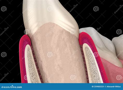 Morphology Of Maxillary Lateral Incisor Tooth And Gum Medically