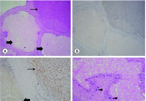 Histology Of Resected Hepatic Mass A Caseating Granulomas Bold Download Scientific Diagram