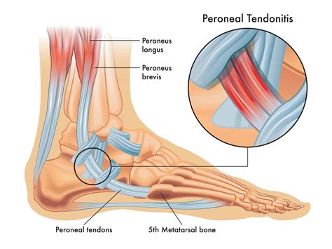 Sports Podiatrys Role In Peroneal Tendonitis Treatment