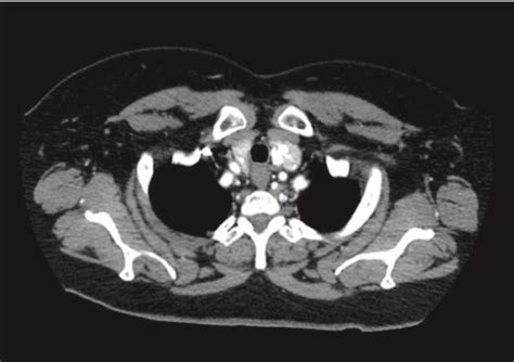 Ct Chest W Contrast Demonstrating Multinodular Goiter Download Scientific Diagram