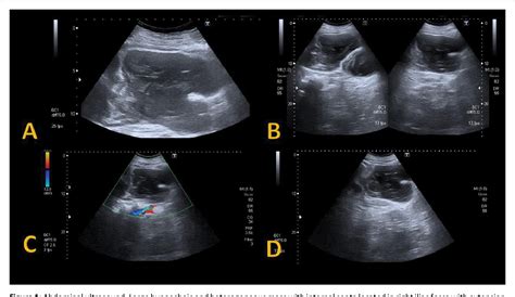 Figure 1 From Mucocele Of The Appendix A Case Report Semantic Scholar