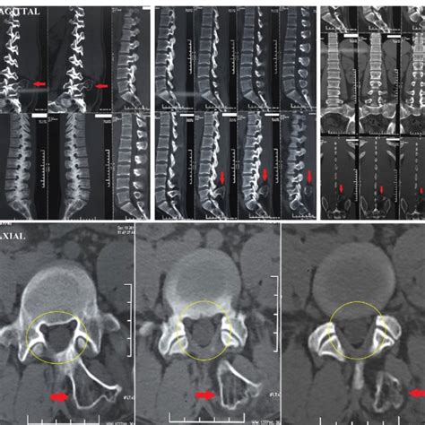 Ct Scan Of The Lumbar Spine At Different Levels Sagittal And Axial