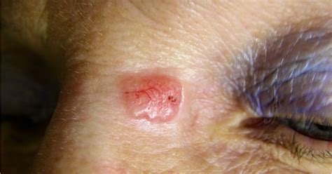 Best Hospitals And Doctors In India For Basal Cell Carcinoma Treatment Ginger Healthcare