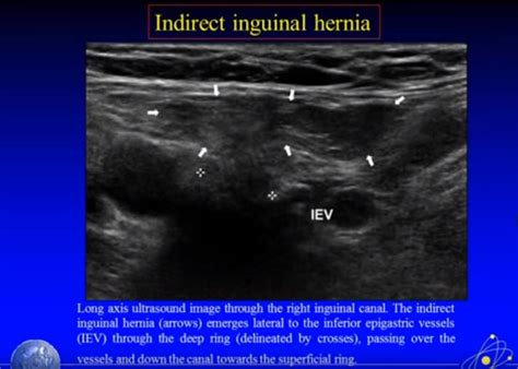 Indirect Inguinal Hernia Ultrasound