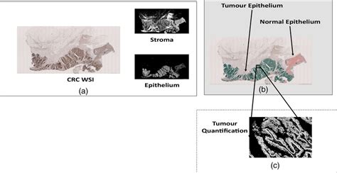 The Different Components Of Tumor Parcellation And Quantification Download Scientific Diagram