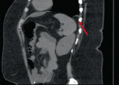 Bilateral Bochdalek Hernias Associated With Arnold‐chiari I