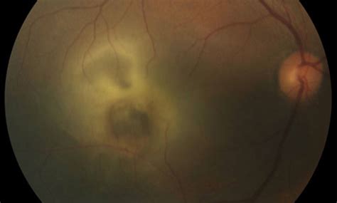 Retinal Syphilis And Tuberculosis In Naples Fl
