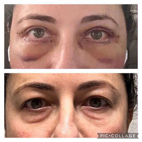 Upper And Lower Bleph 5 Days Ago Rplasticsurgery