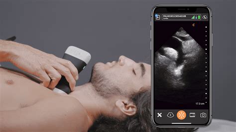 Pal Suprasternal Notch View Clarius