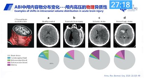 陈文劲教授：颅内压与脑灌注 脑医汇