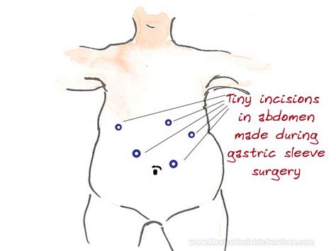 Incisions From Gastric Sleeve At Eloise Rameriz Blog