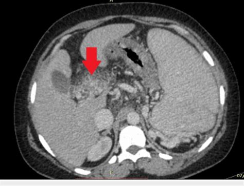 Ct Scan Of Abdomen Axial View Showing Collaterals Or Cavernoma