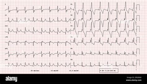 Ecg Example Of A Pathological 12 Lead Rhythm Fallots Tetralogy Stock