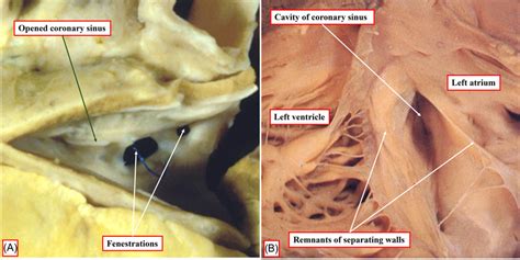 Coronary Sinus Opening