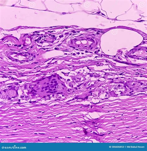 Thyroid Cancer Microscopic Image Of Follicular Neoplasm Malignant Neoplasm Of Atypical Thyroid